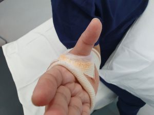 Forearm cast – Plaster Room