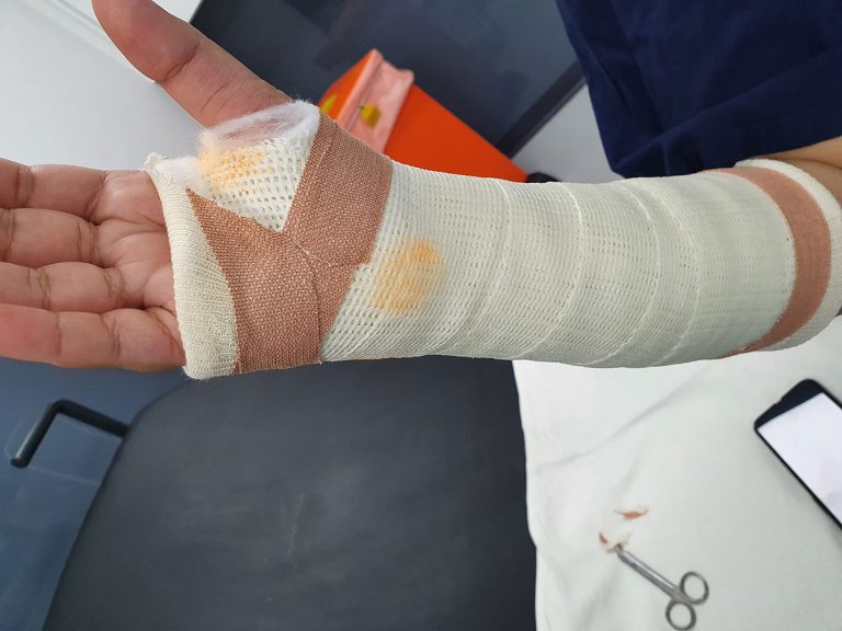 Forearm cast – Plaster Room