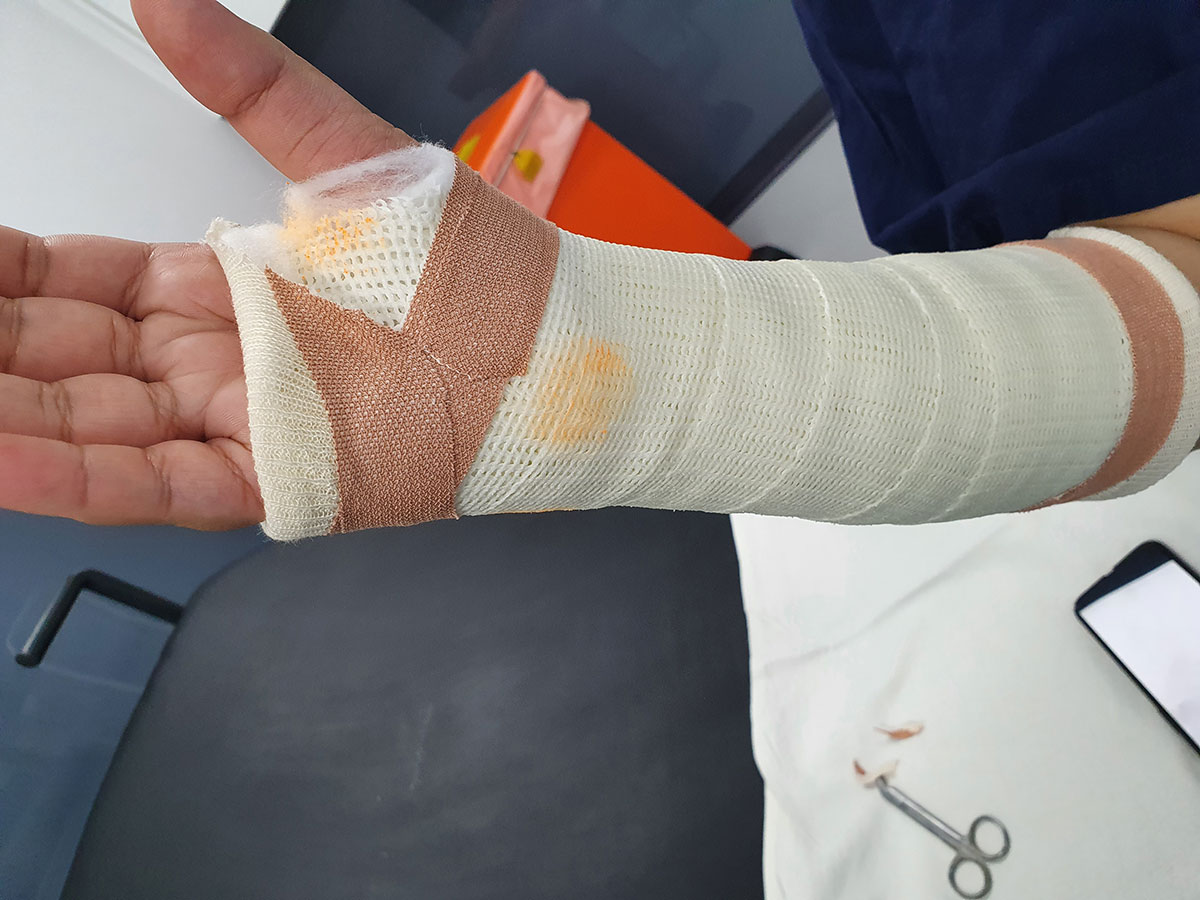 Forearm cast – Plaster Room