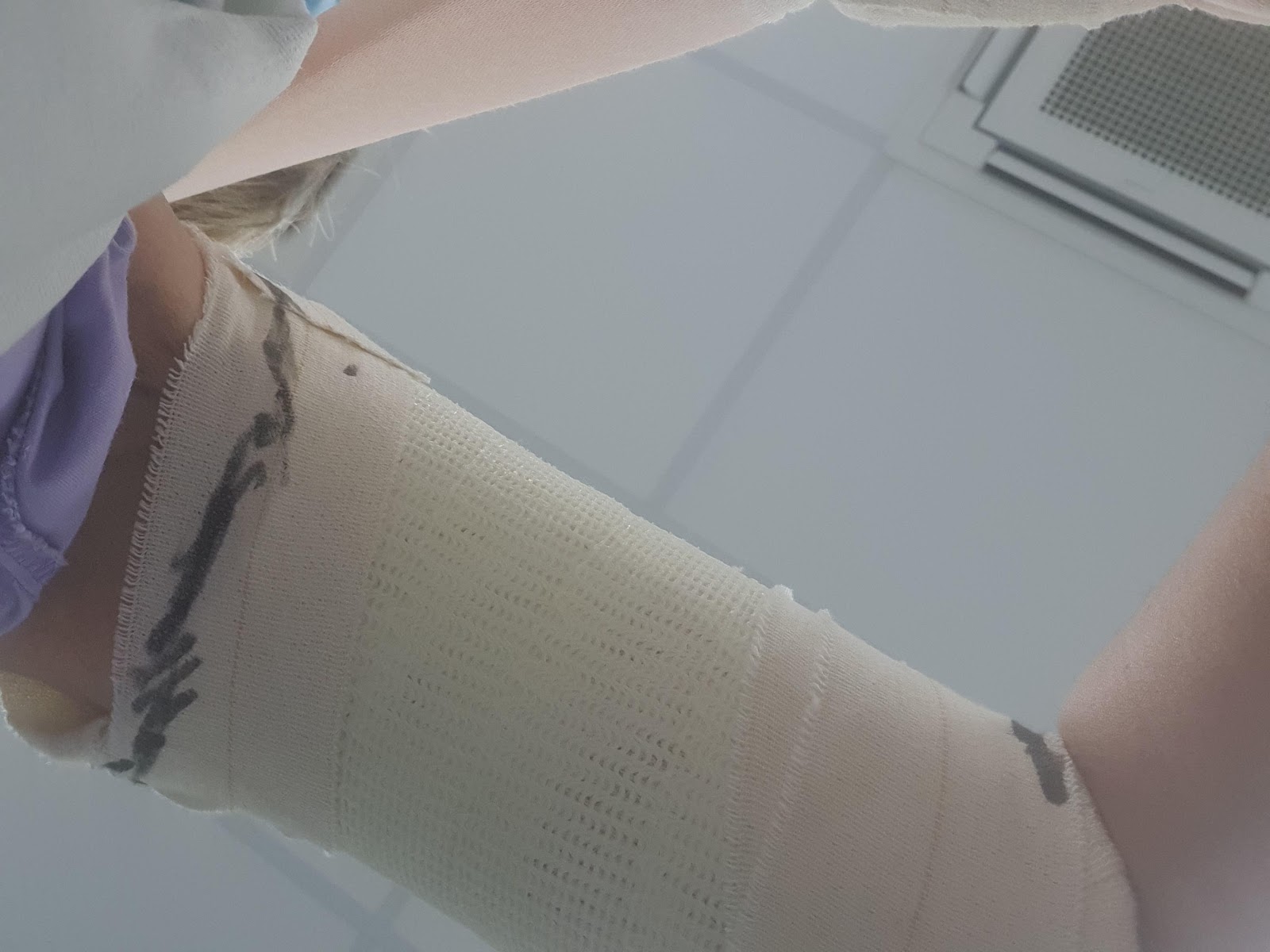 Humeral brace – Plaster Room