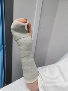 Volar/ulnar gutter splint – Plaster Room