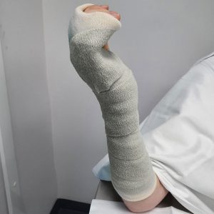 Volar/ulnar gutter splint – Plaster Room