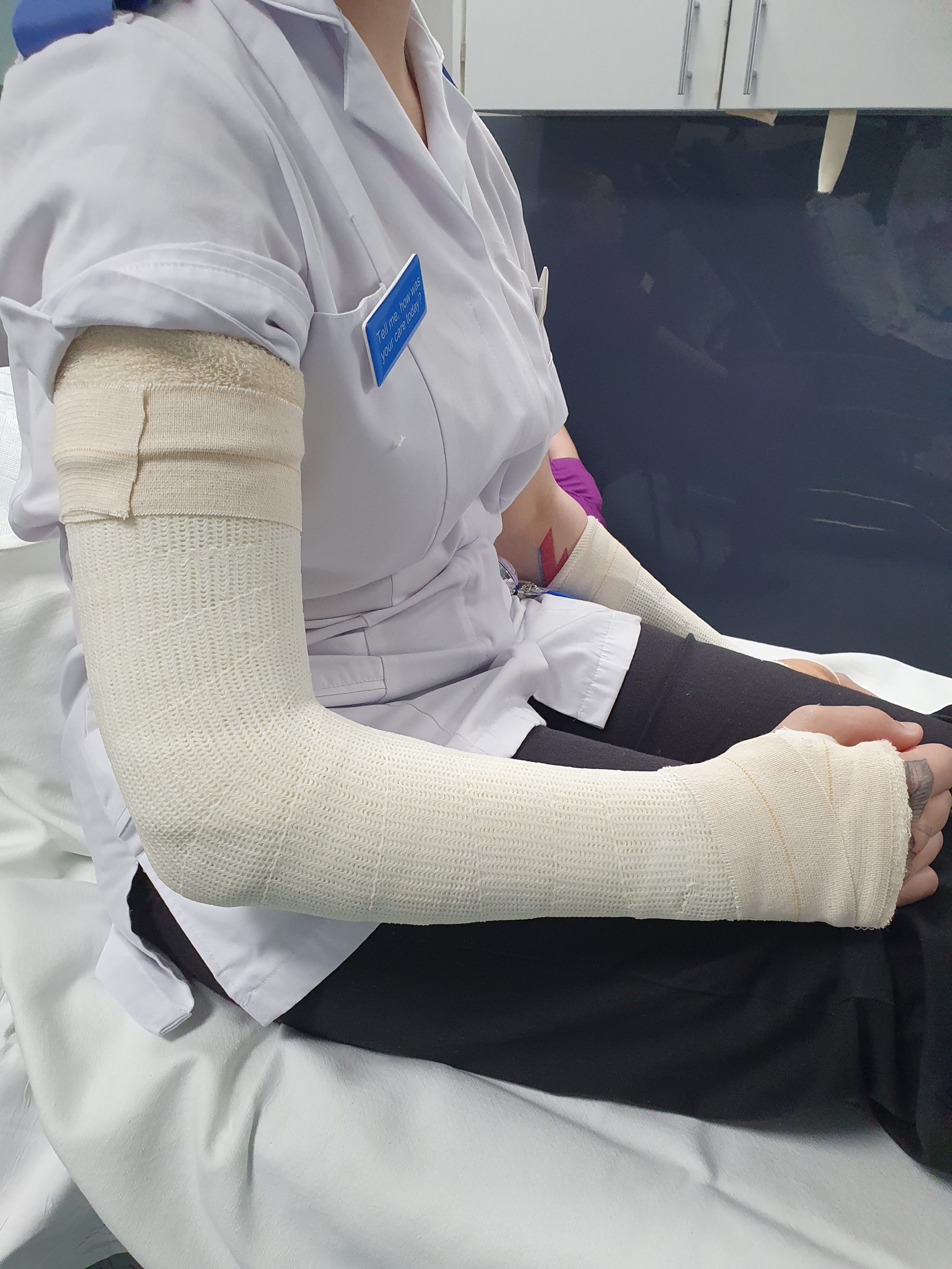 Above elbow cast – Plaster Room