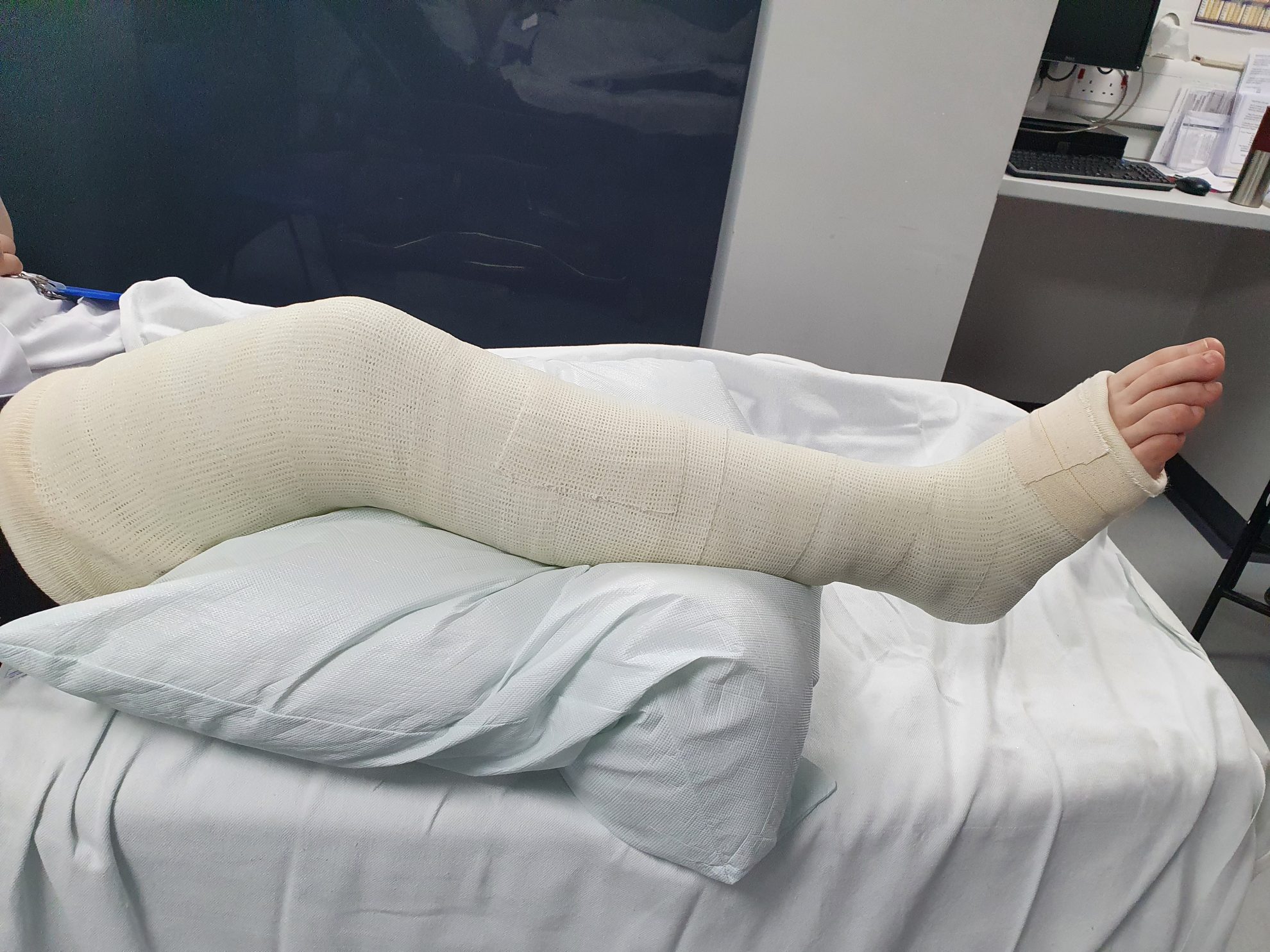 Above knee cast – Plaster Room