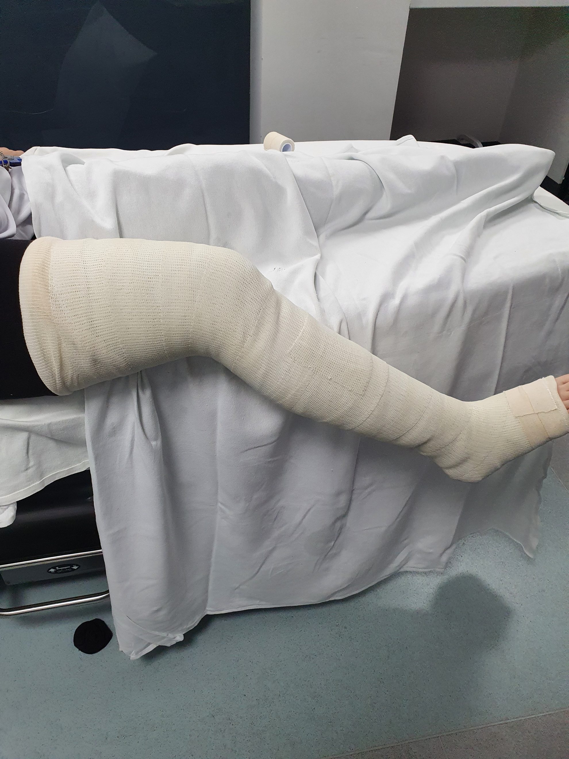 Above knee cast – Plaster Room