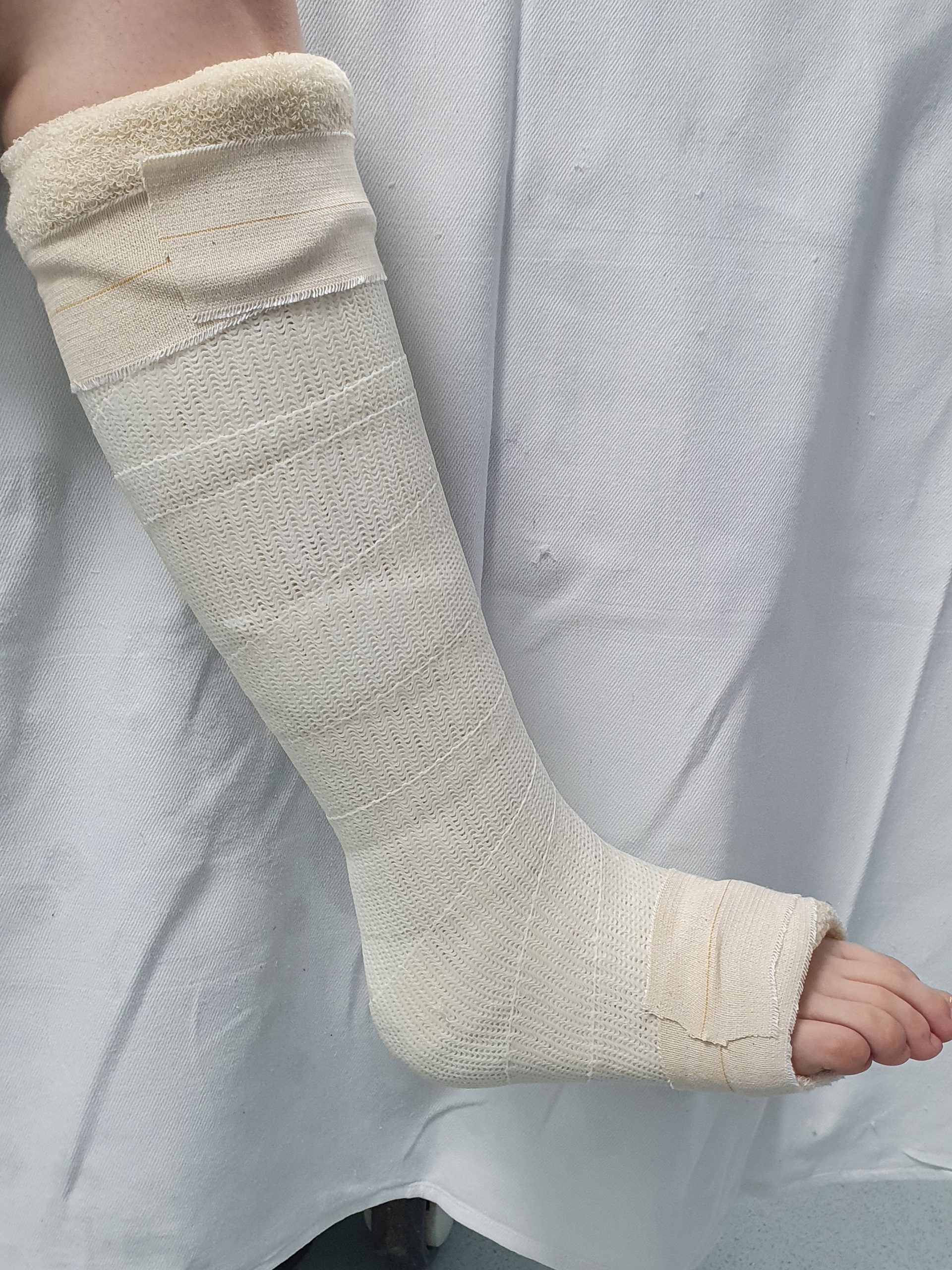 Below knee cast – Plaster Room