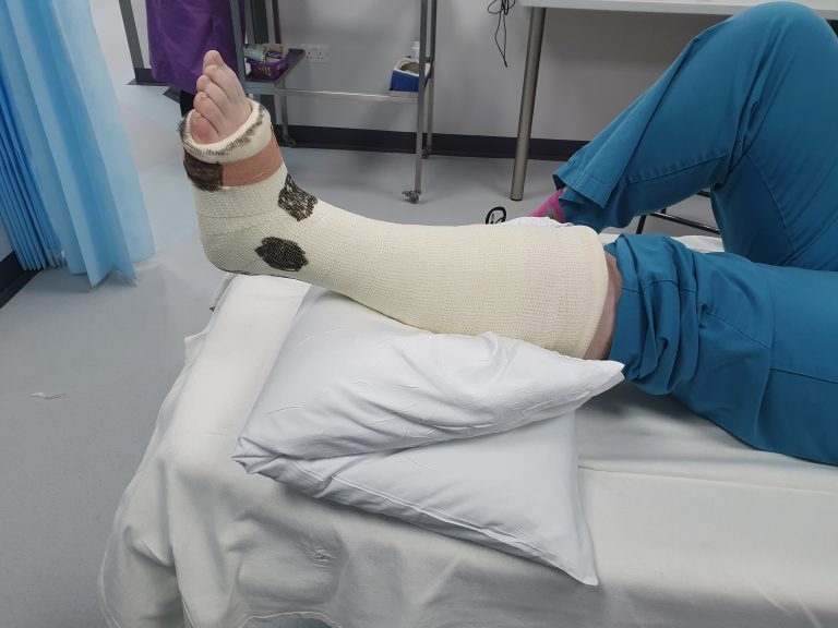 Below knee cast – Plaster Room